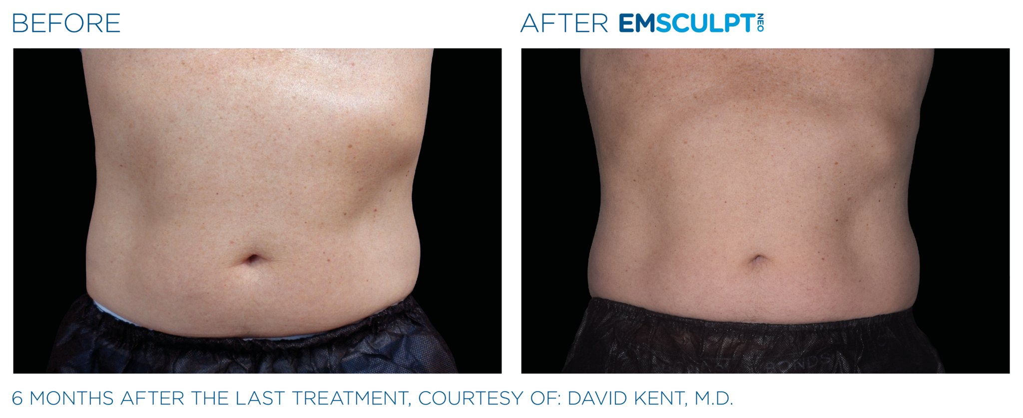Emsculpt Neo - Vitality Medicine